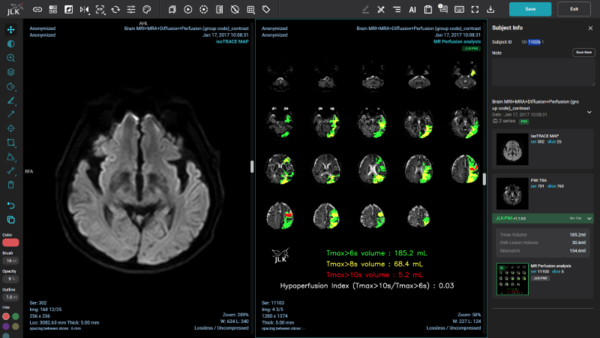 제이엘케이, 뇌졸중 솔루션(JLK-PWI) 올해 2번째 일본 PMDA 인허가 획득
