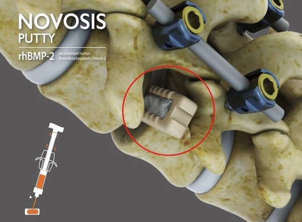 시지바이오 '노보시스 퍼티', 美 FDA 확증임상 승인